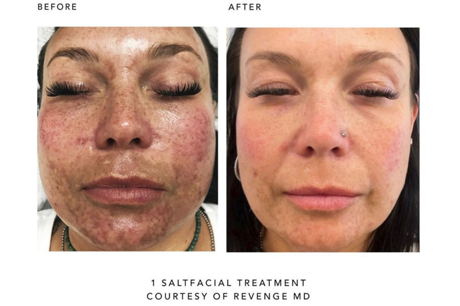 Salt Facial in Mystic, CT | Cure Med Spa