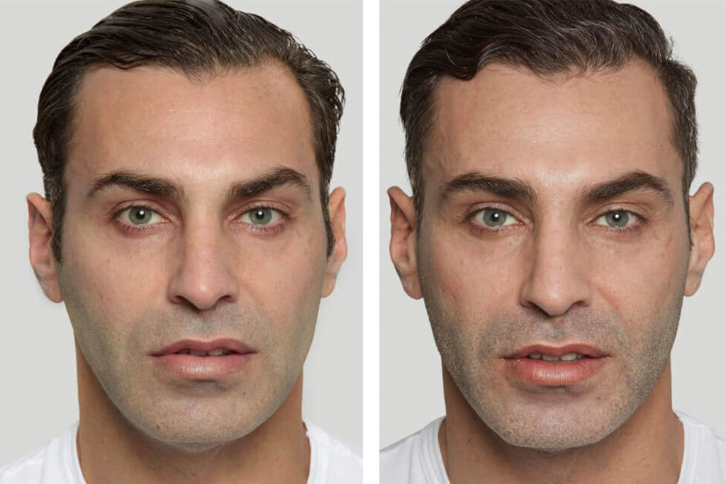 Sculptra in Mystic, CT | Cure Med Spa