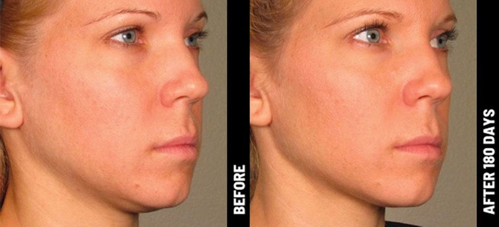 Ultherapy in Mystic, CT | Cure Med Spa
