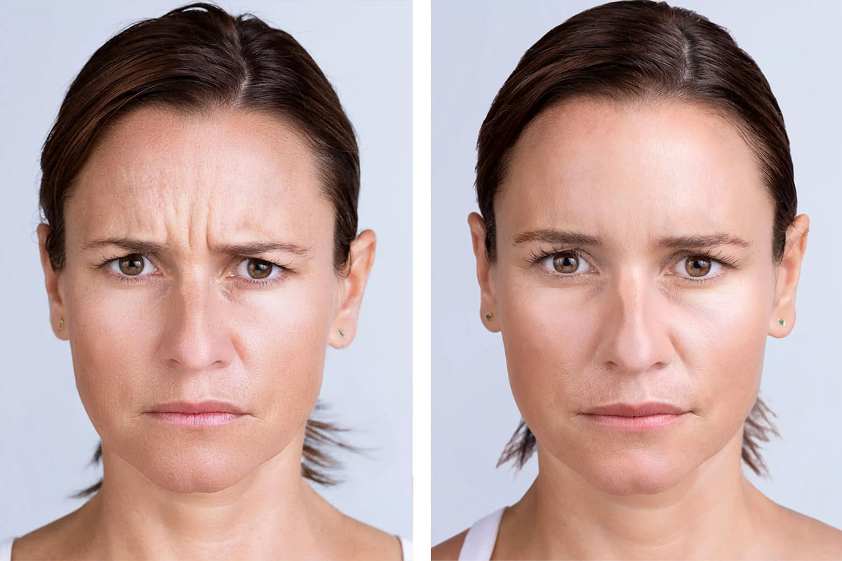 Xeomin in Mystic, CT | Cure Med Spa