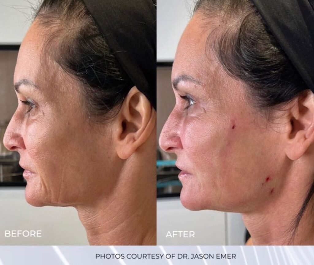 PDO Threads in Connecticut | Cure Med Spa