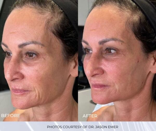 PDO Threads in Connecticut | Cure Med Spa