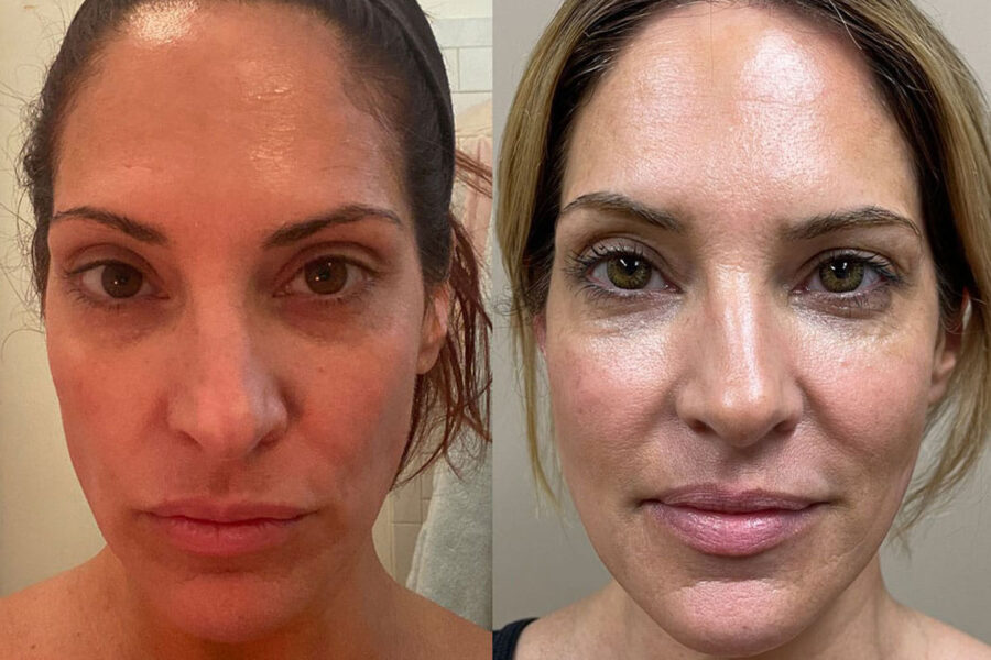 PDO Threads in Connecticut | Cure Med Spa