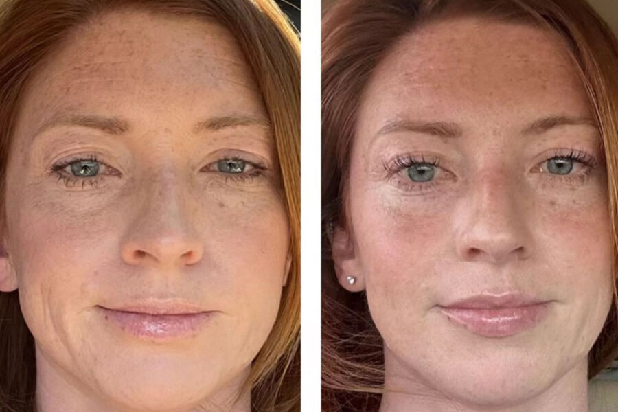 Xeomin in Mystic, CT | Cure Med Spa