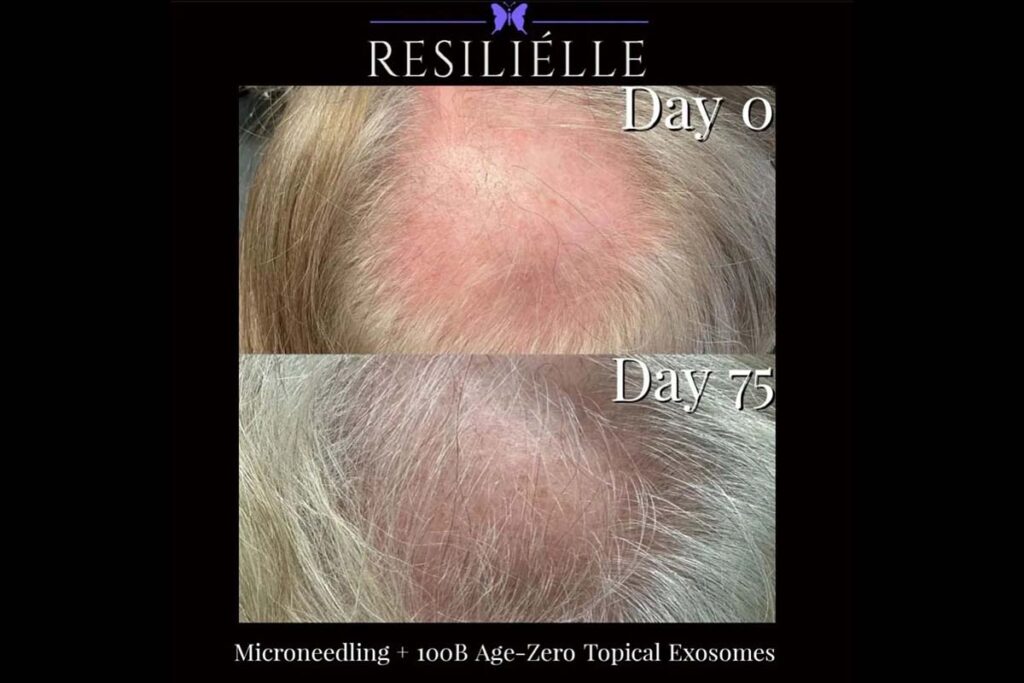 Hair Restoration in Mystic, CT | Cure Med Spa